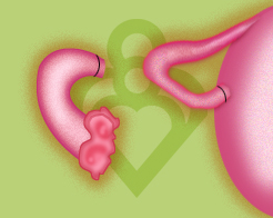 Parkland and Irving Methods Fertility Answers