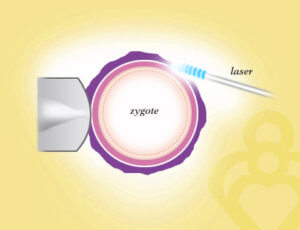 Assisted Hatching - Improved Pregnancy Rate - Lafayette IVF