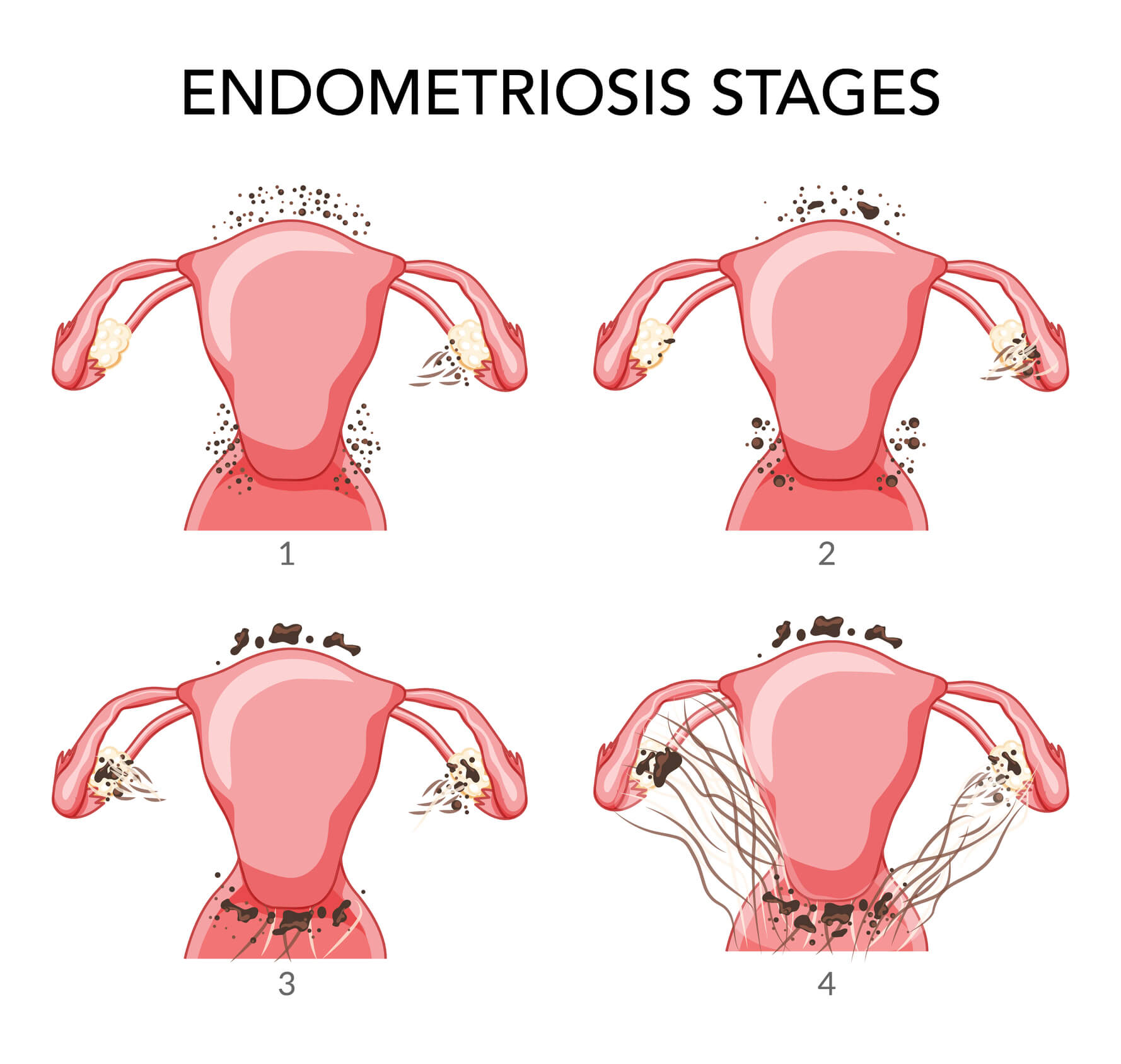 What to Know About Stages of Endometriosis - Fertility Answers